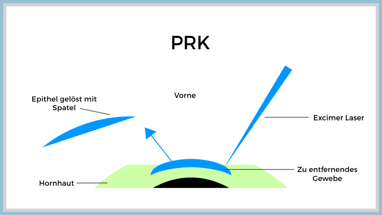 PRK Laser Eye Surgery in Turkey / Istanbul: Procedure & Prices
